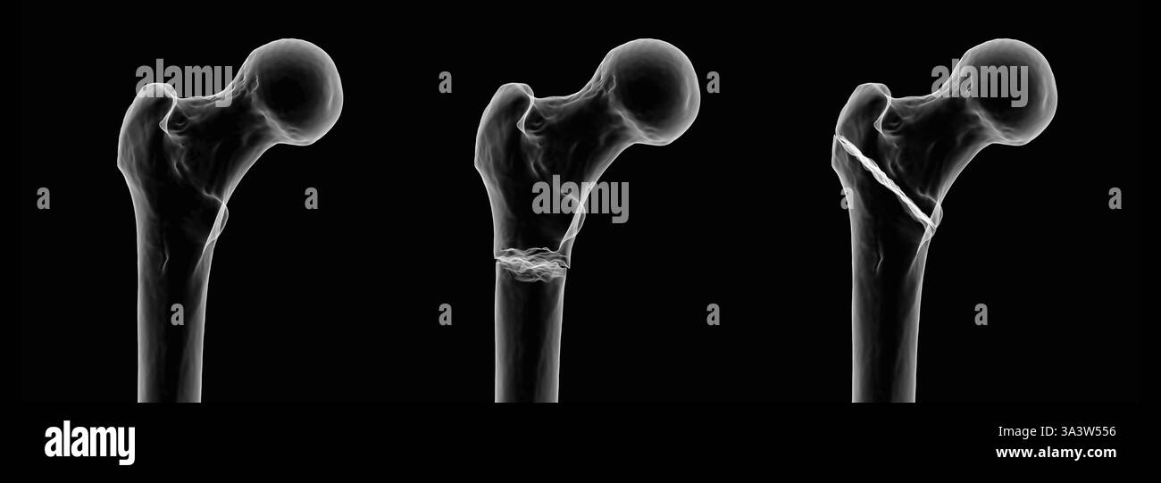 Bone fracture types hi-res stock photography and images - Alamy