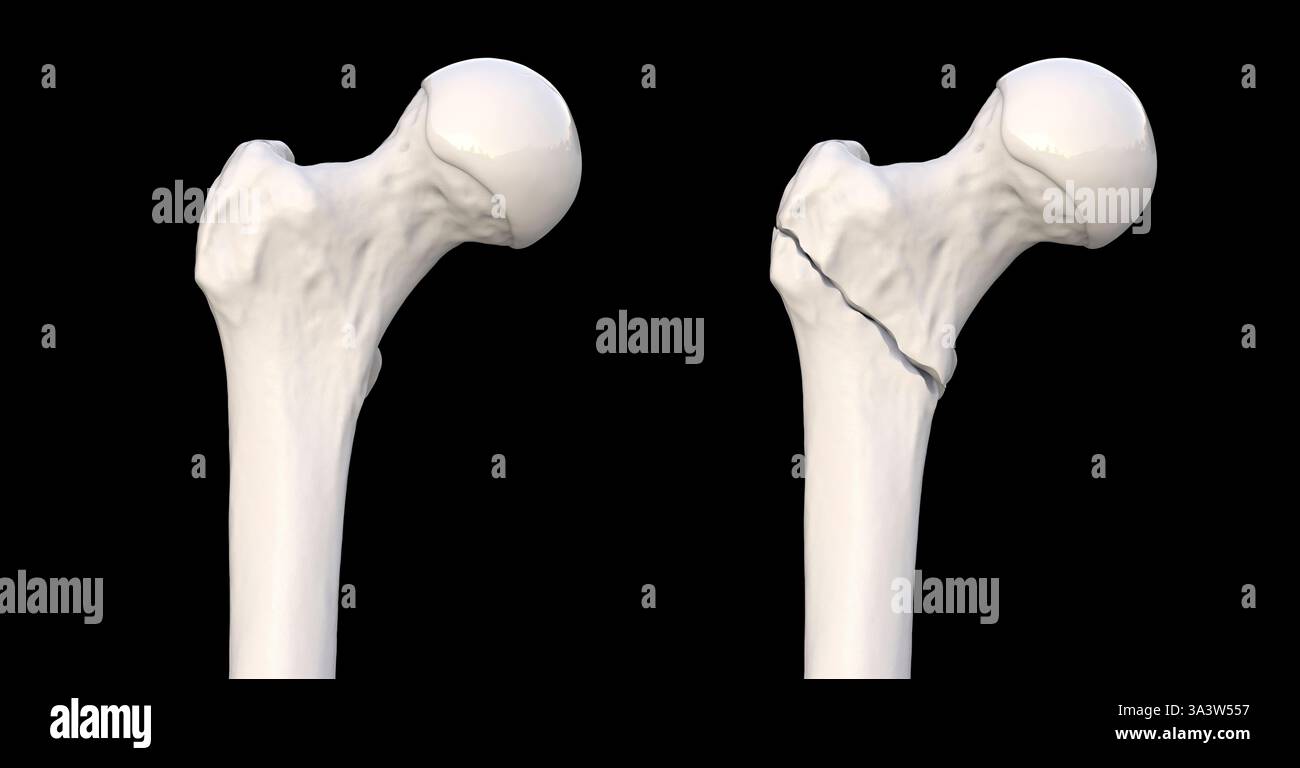 Illustration of an intertrochanteric femur fracture (right) showing a ...