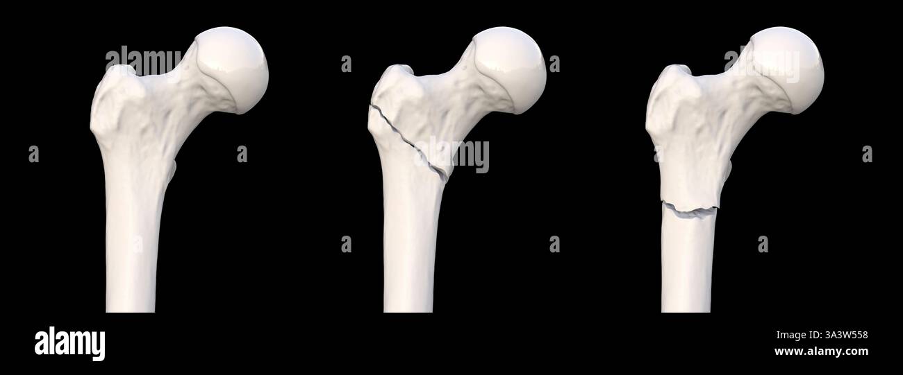 Hip fracture proximal femur hi-res stock photography and images - Alamy