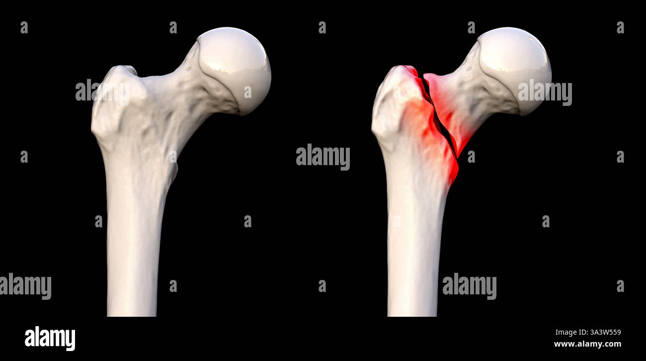 Illustration of a basicervical femur fracture (right) showing a break ...