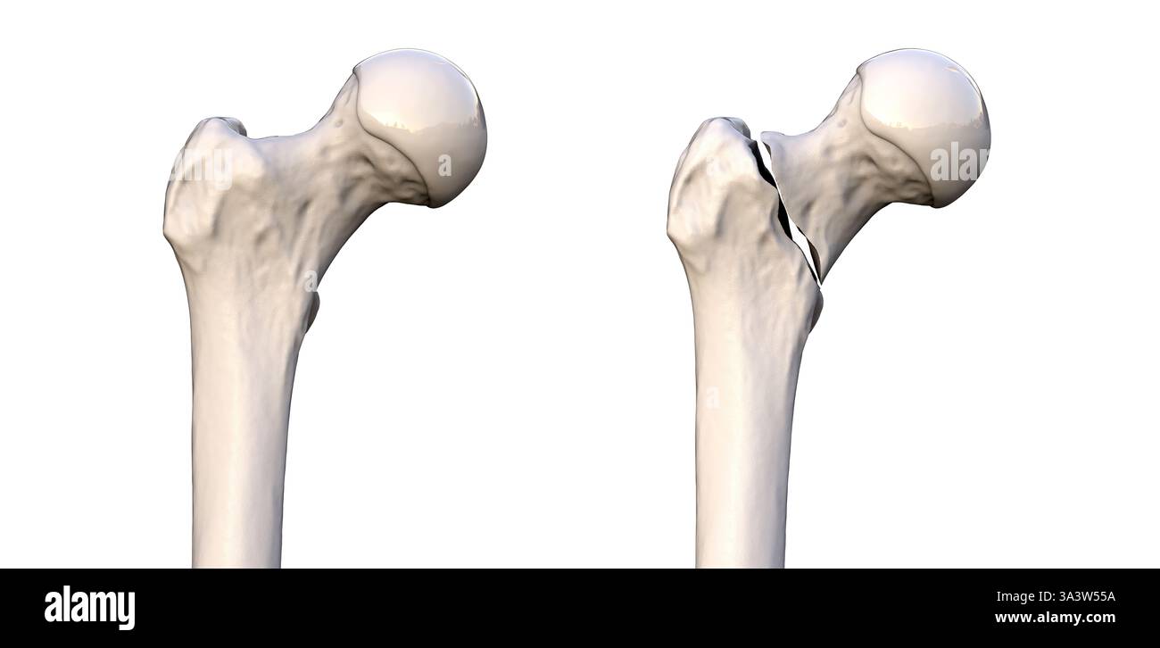Illustration of a basicervical femur fracture (right) showing a break ...