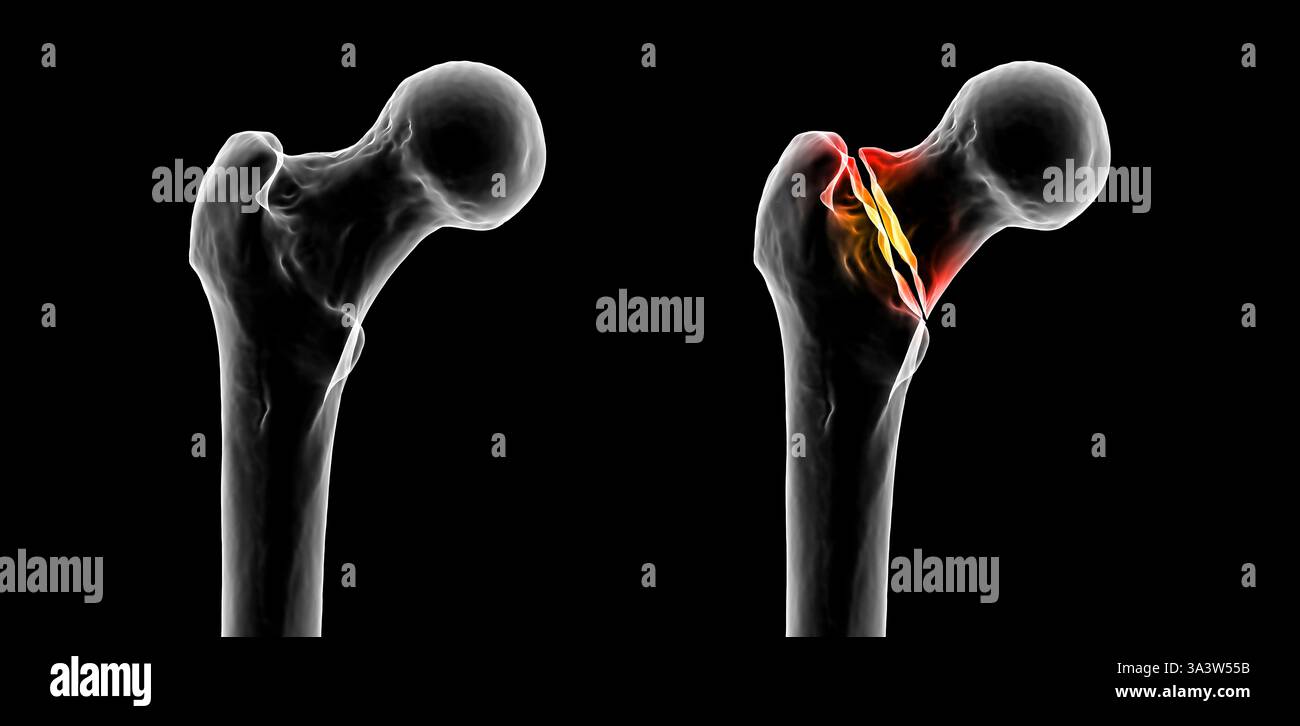 Illustration of a basicervical femur fracture (right) showing a break ...