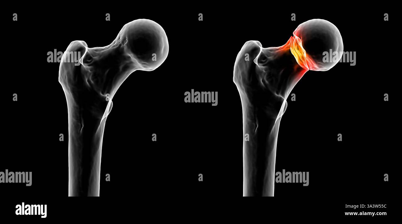 Illustration of a subcapital femur fracture (right) showing a break ...
