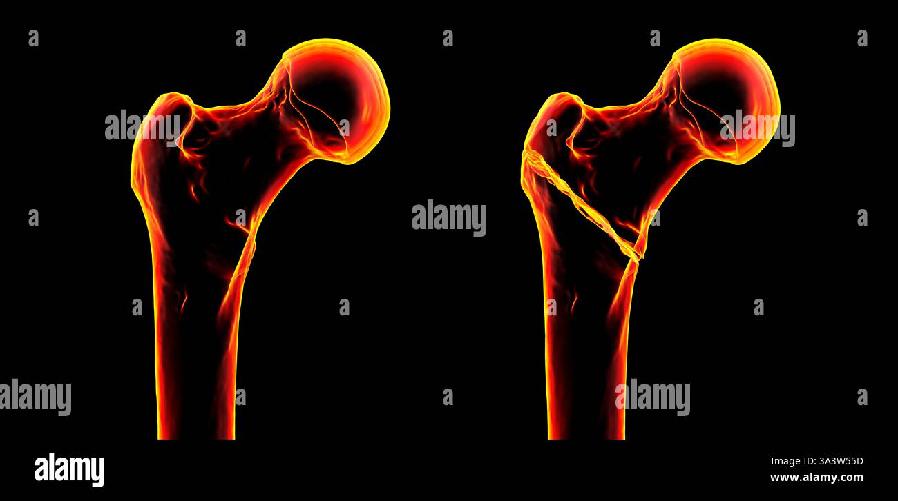 Illustration of an intertrochanteric femur fracture (right) showing a ...