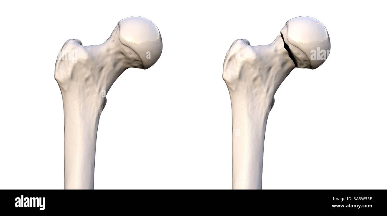 Illustration of a subcapital femur fracture (right) showing a break ...