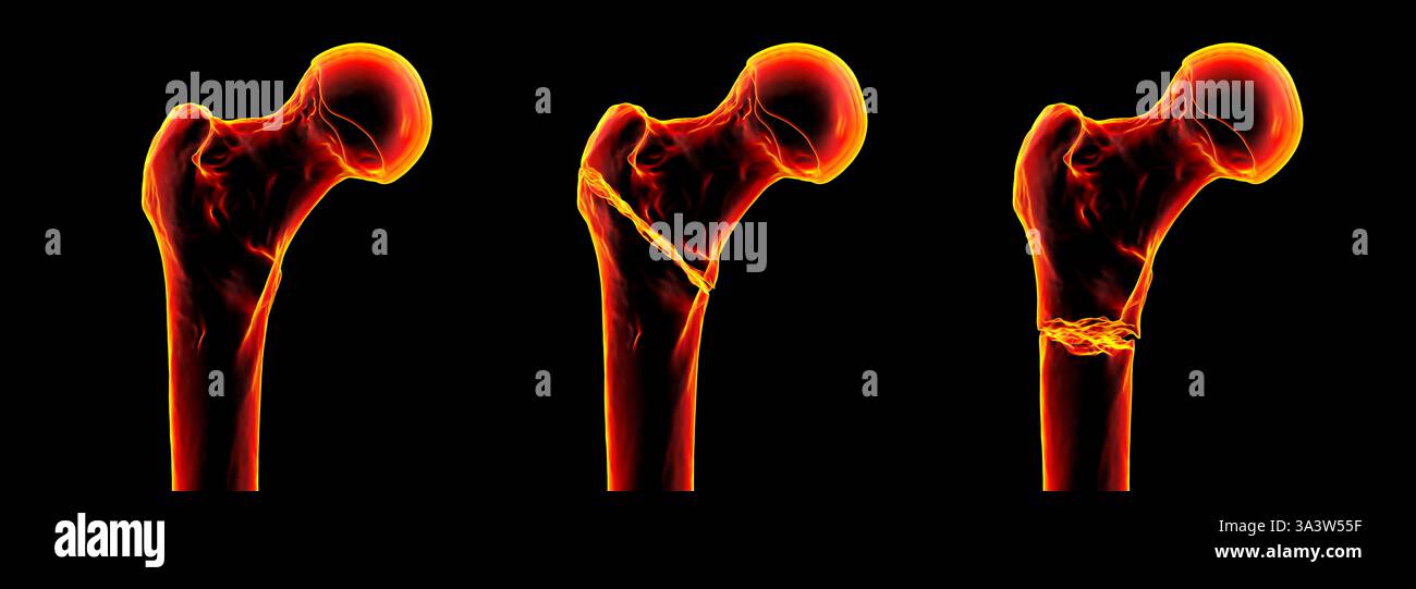 Bone fracture types hi-res stock photography and images - Alamy