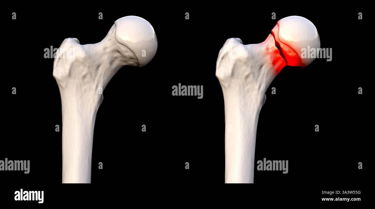 Illustration of a subcapital femur fracture (right) showing a break ...