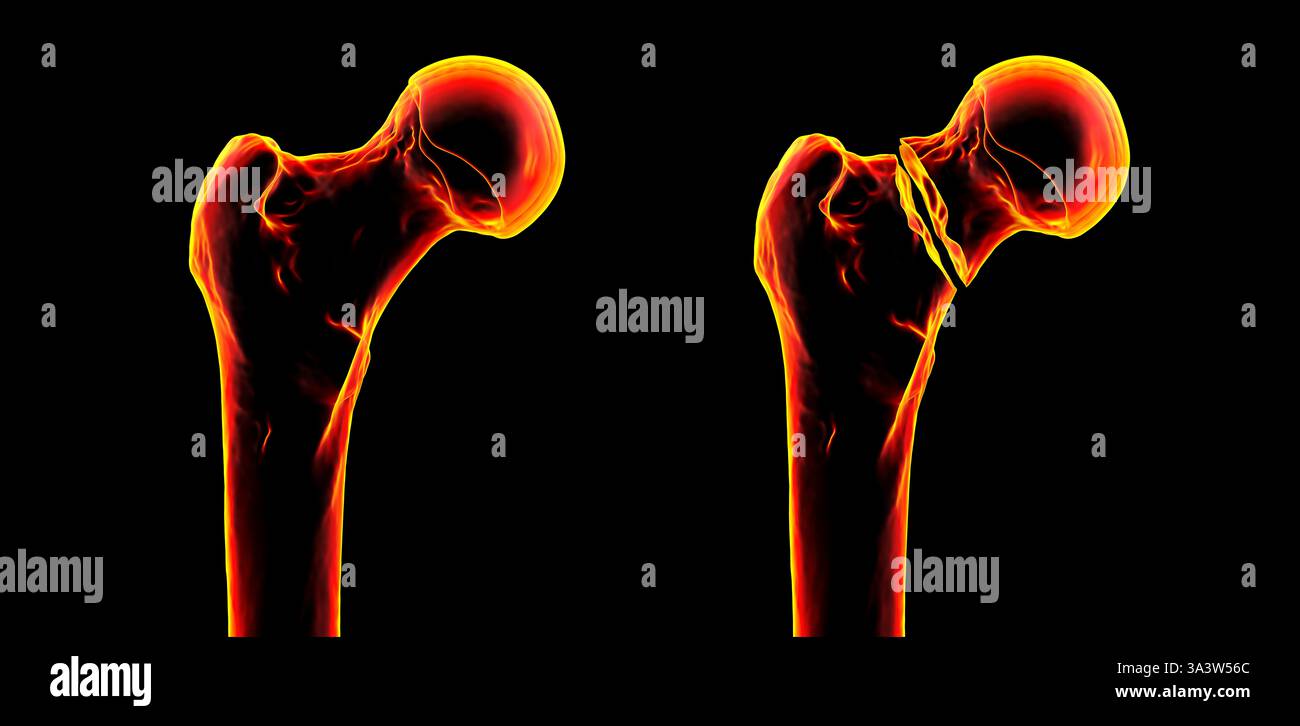 Illustration of a transcervical femur fracture (right) depicting a ...