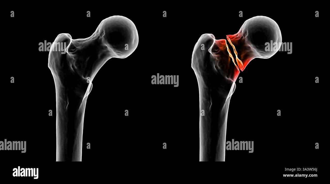 Illustration of a transcervical femur fracture (right) depicting a ...