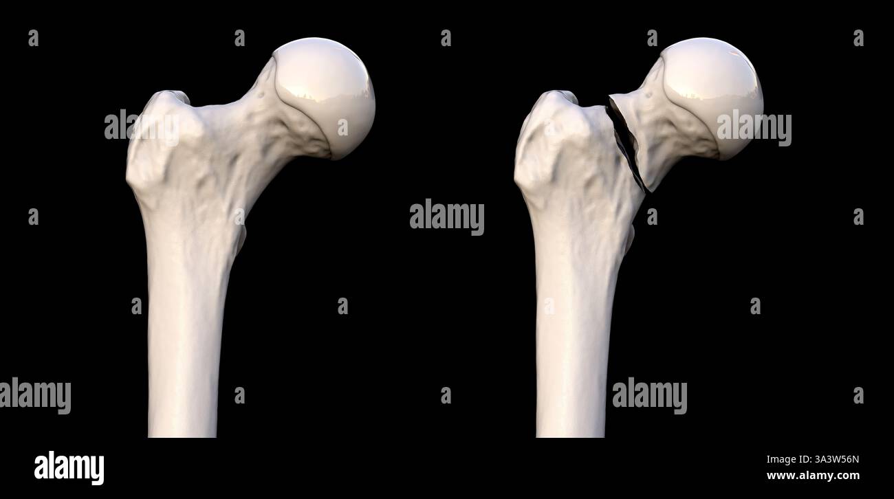 Illustration of a transcervical femur fracture (right) depicting a ...