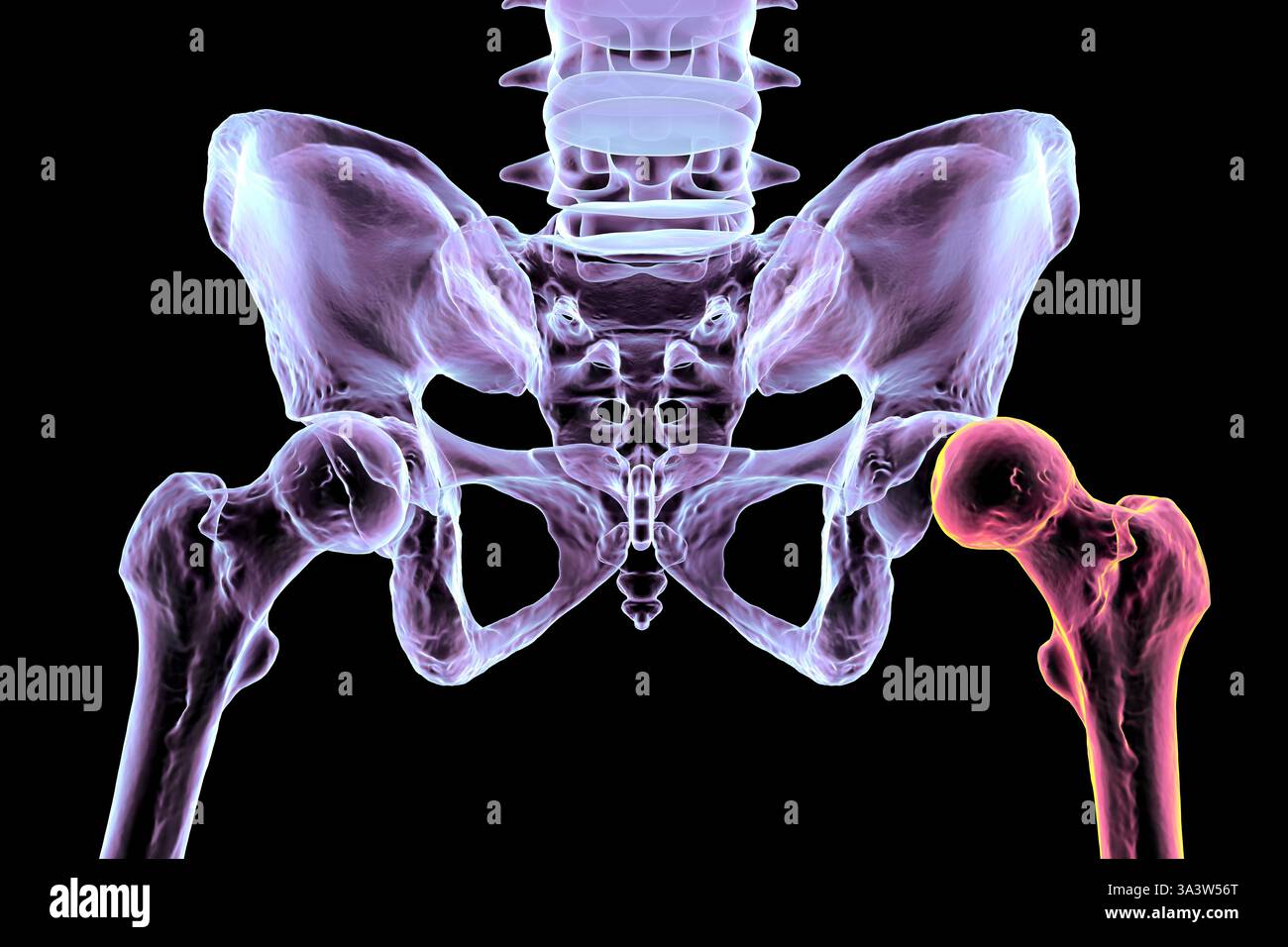 Illustration of hip dysplasia (subluxation type), showing partial ...