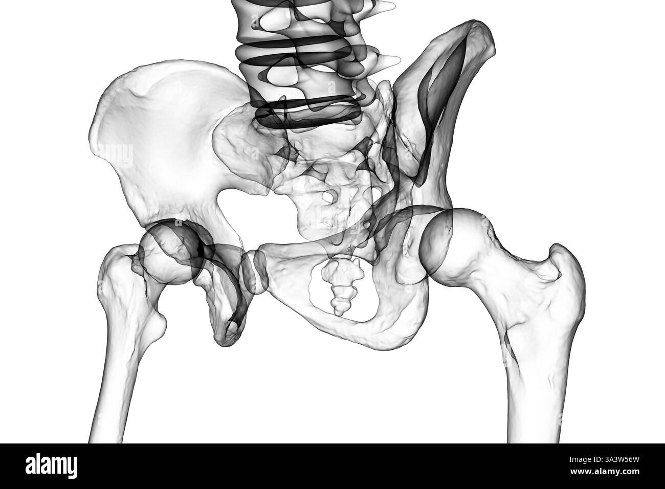 Illustration of hip dysplasia (dislocation type), showing misalignment ...