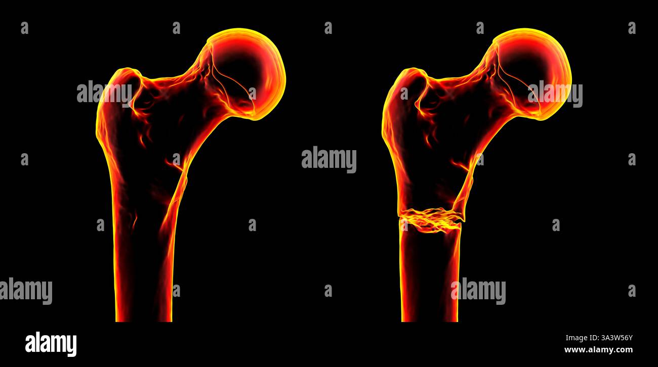 Illustration of a subtrochanteric femur fracture (right) depicting a ...