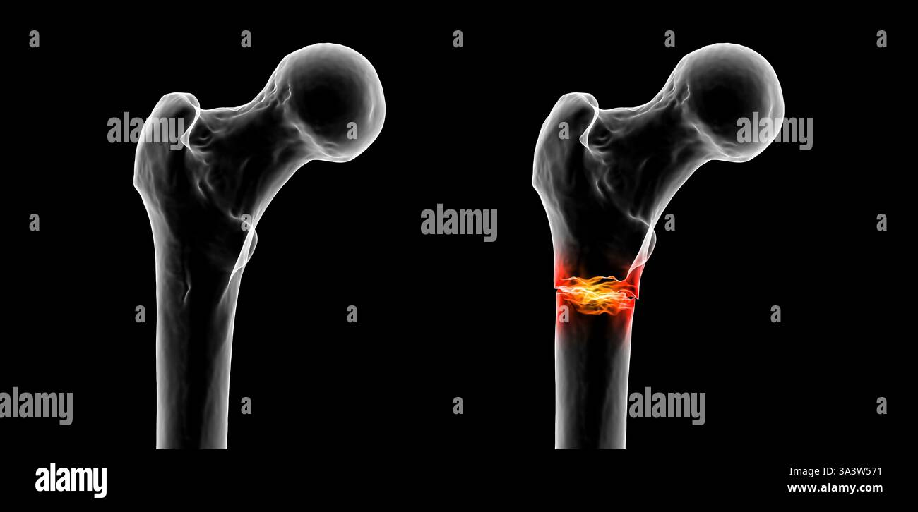 Illustration of a subtrochanteric femur fracture (right) depicting a ...