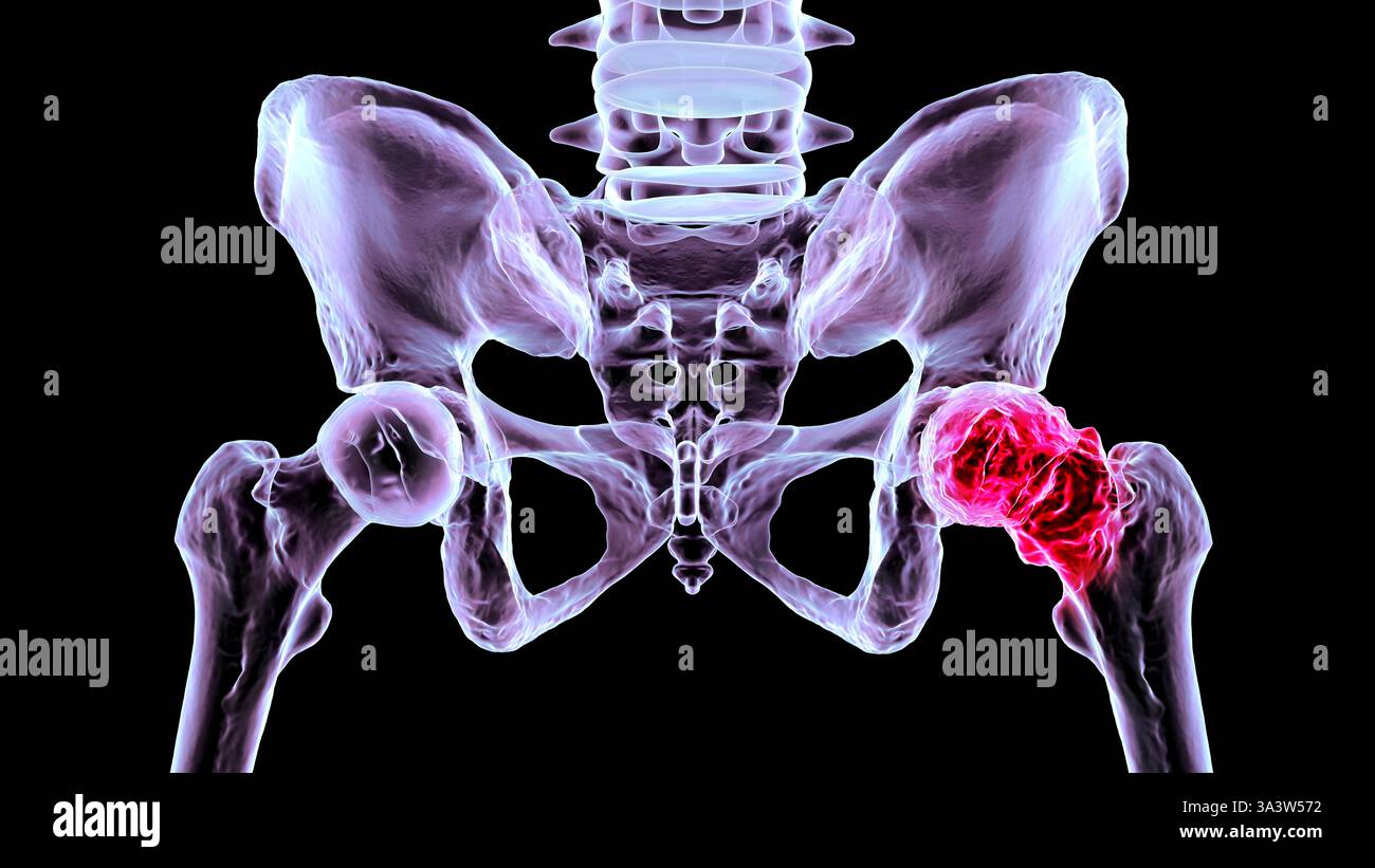 Illustration of hip osteoarthritis, showing joint degeneration ...