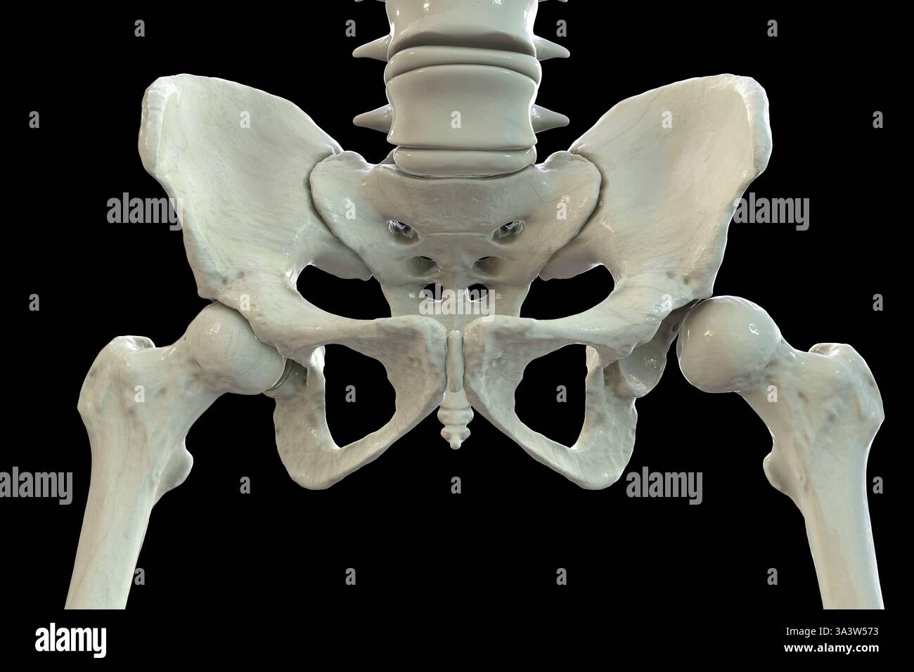 Illustration of hip dysplasia (dislocation type), showing misalignment ...