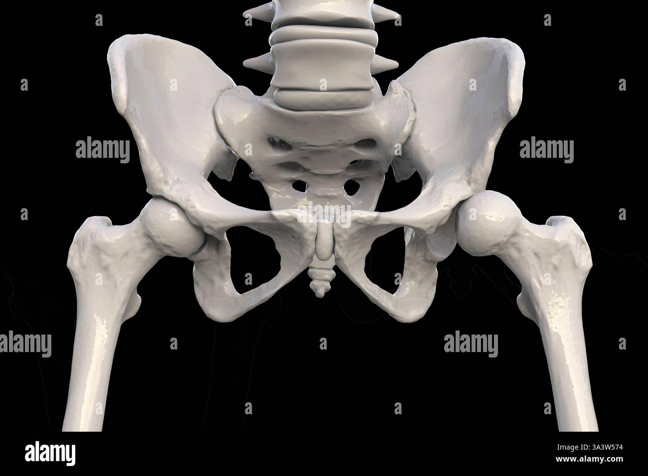 Illustration of hip dysplasia (subluxation type), showing partial ...