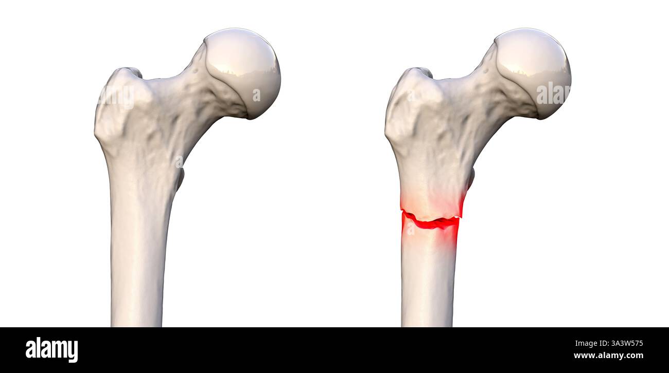 Illustration of a subtrochanteric femur fracture (right) depicting a ...