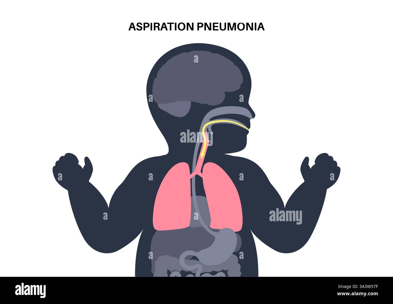 Baby airway infection hi-res stock photography and images - Alamy