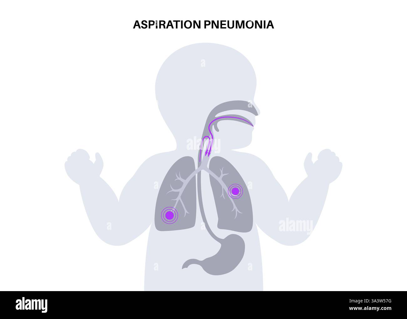 Aspiration pneumonia in a baby, illustration. Aspiration pneumonia is a ...