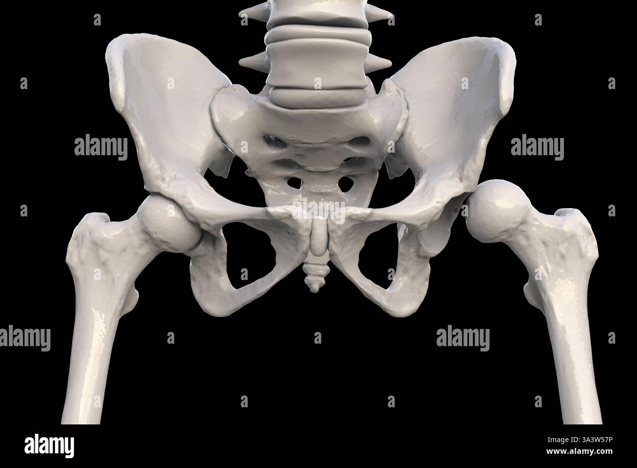 Illustration of hip dysplasia (dislocation type), showing misalignment ...