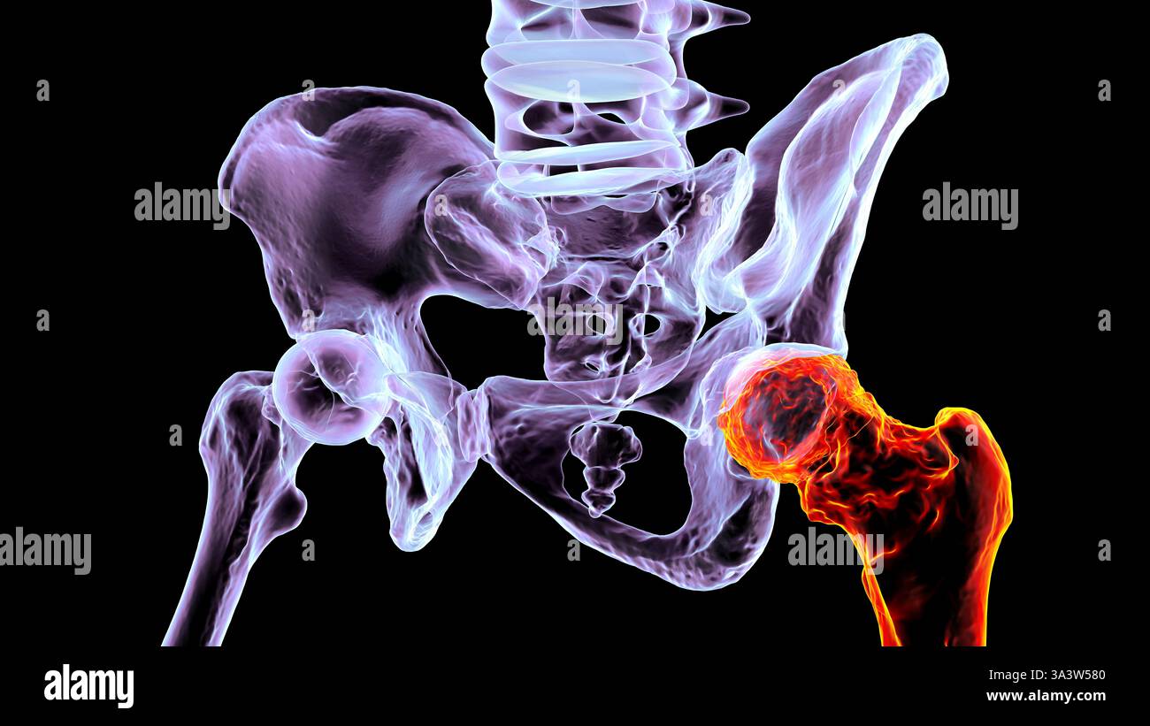Illustration of hip osteoarthritis, showing joint degeneration ...
