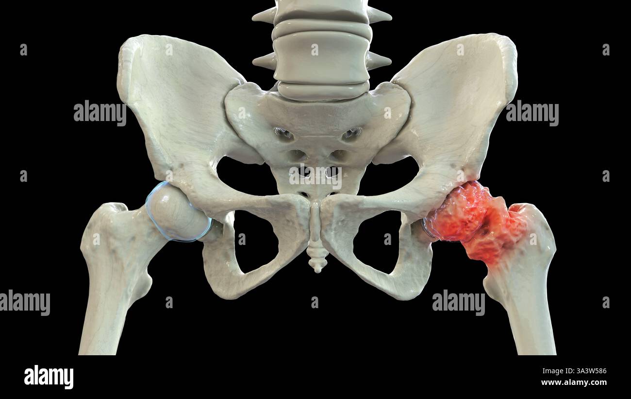 Illustration of hip osteoarthritis, showing joint degeneration ...