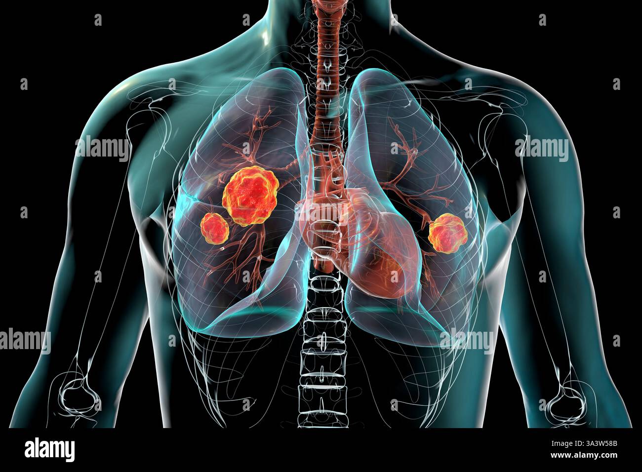 Illustration of lung mucormycosis, a fungal infection caused by Mucorales fungi, showing ...