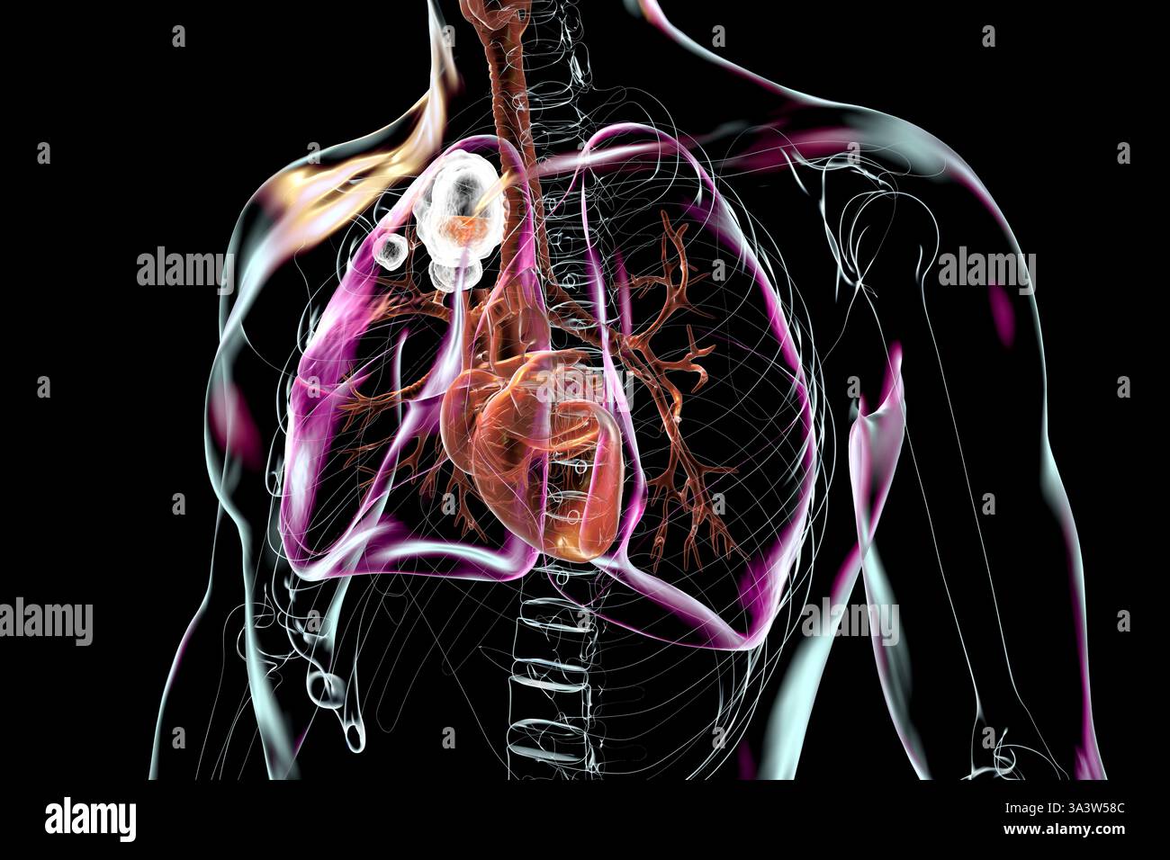 Illustration of cavitary tuberculosis in the upper lobe of the right ...