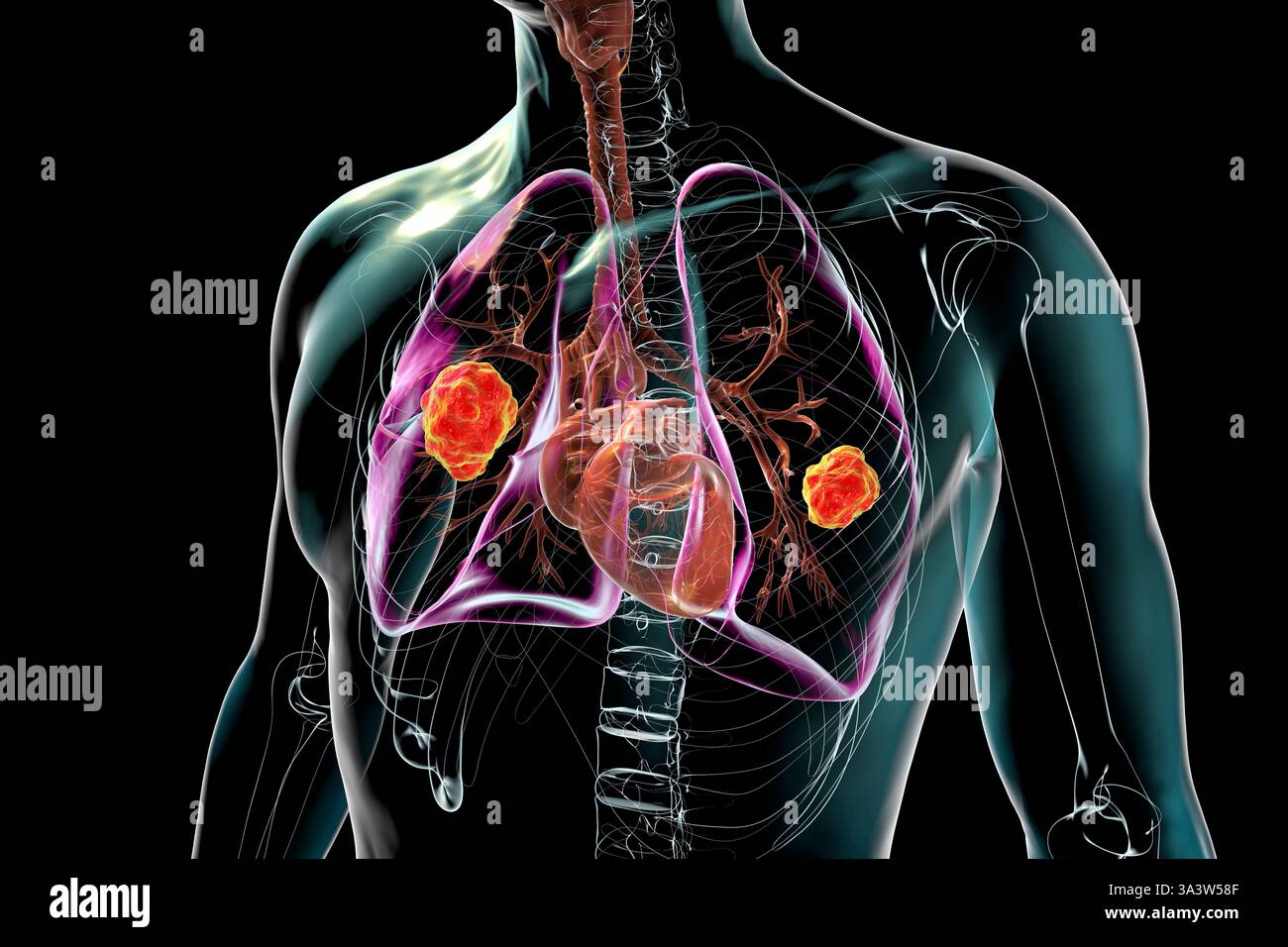 Illustration of lung mucormycosis, a fungal infection caused by ...