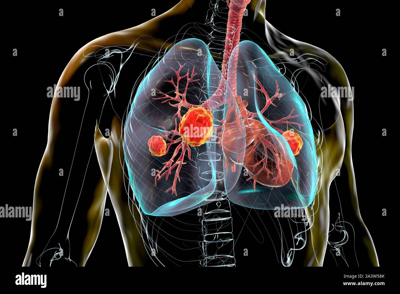 Illustration of lung mucormycosis, a fungal infection caused by ...