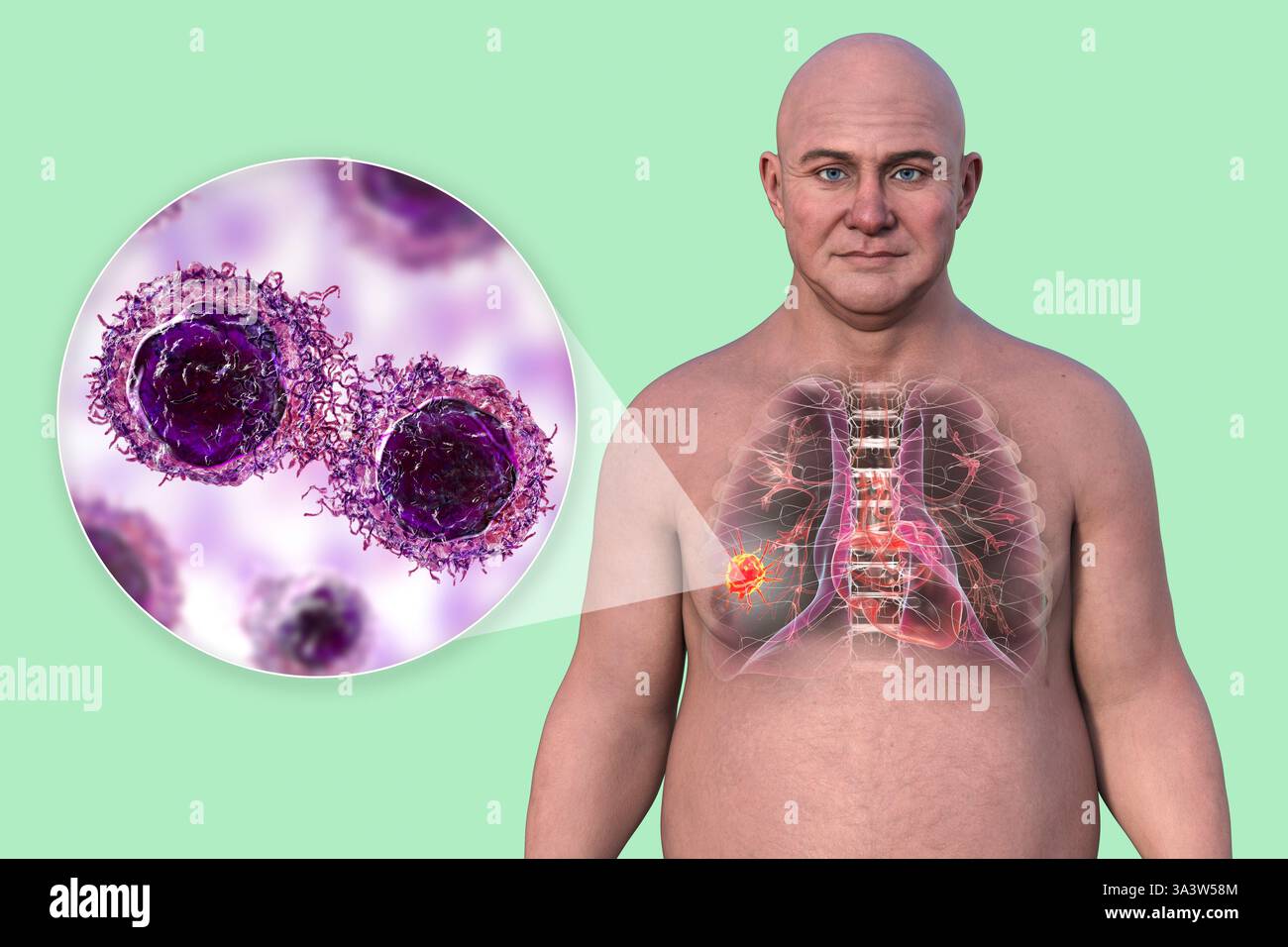 Illustration of man with lung cancer, showing the location and gross ...