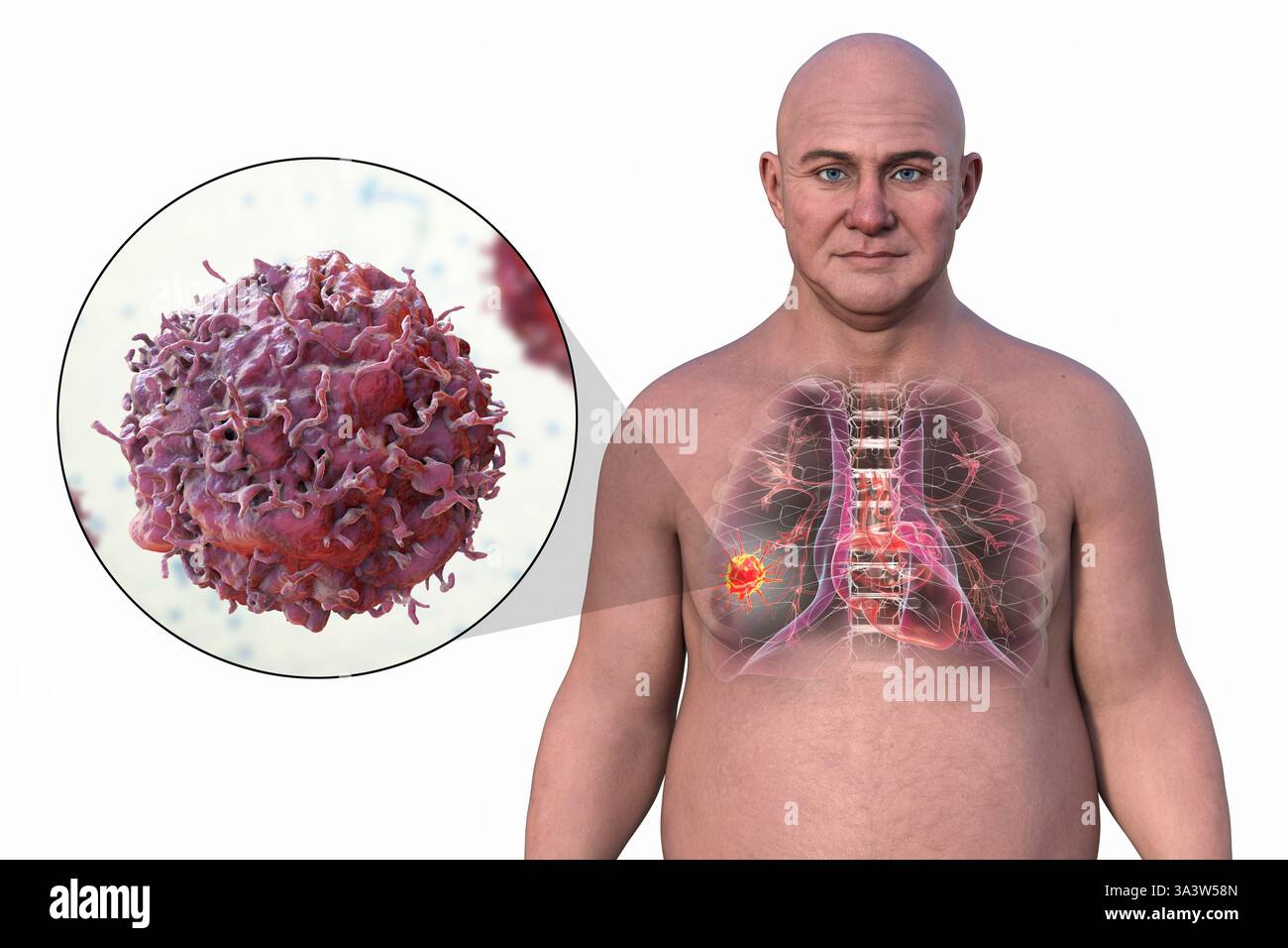 Illustration of man with lung cancer, showing the location and gross ...
