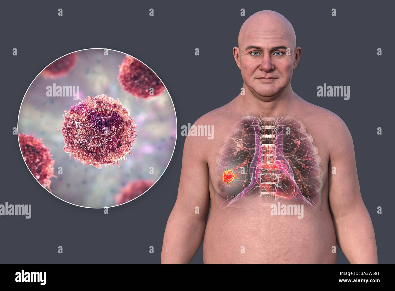 Illustration of man with lung cancer, showing the location and gross ...