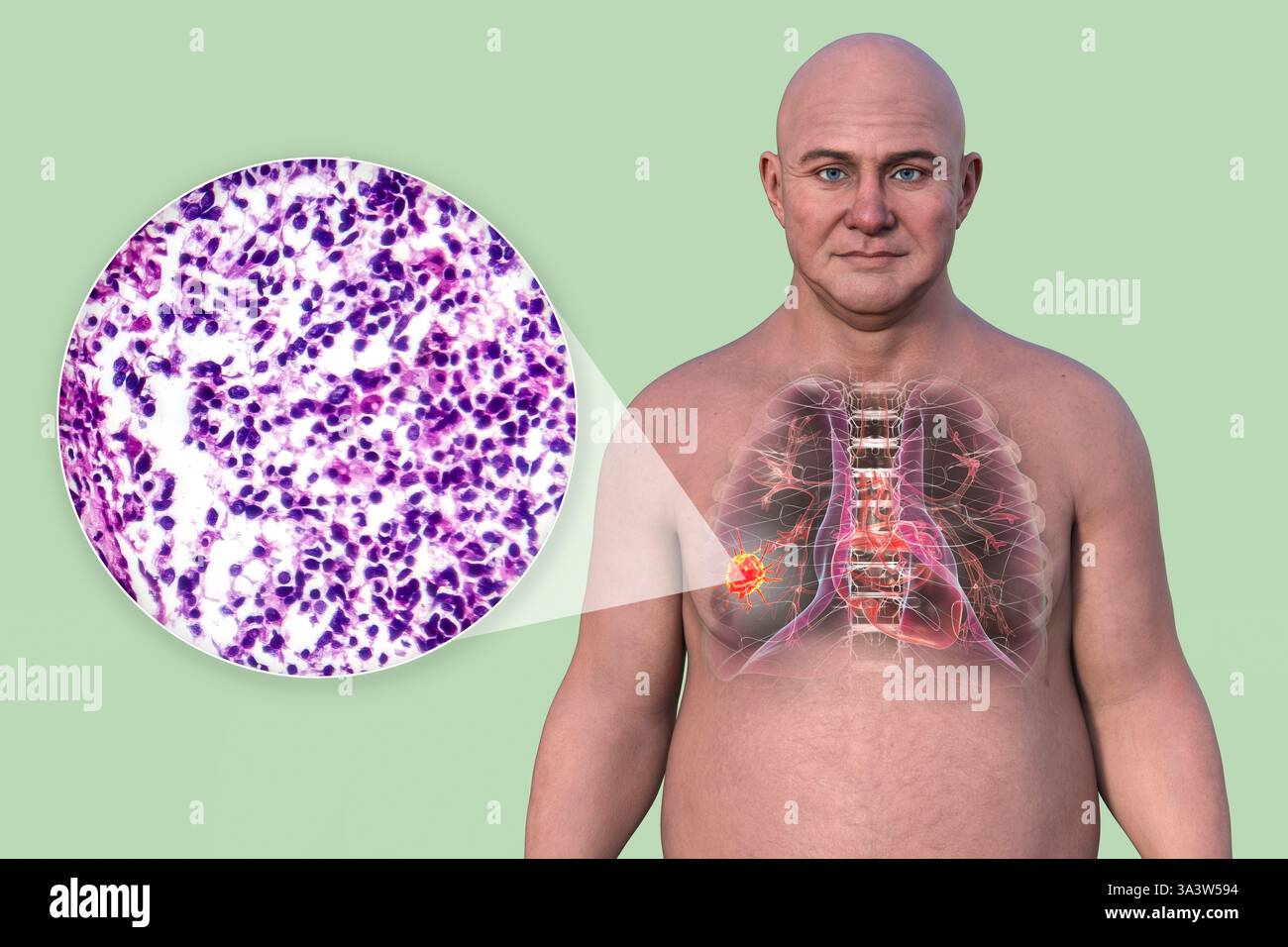Illustration of a man with lung cancer, showing the location and gross ...