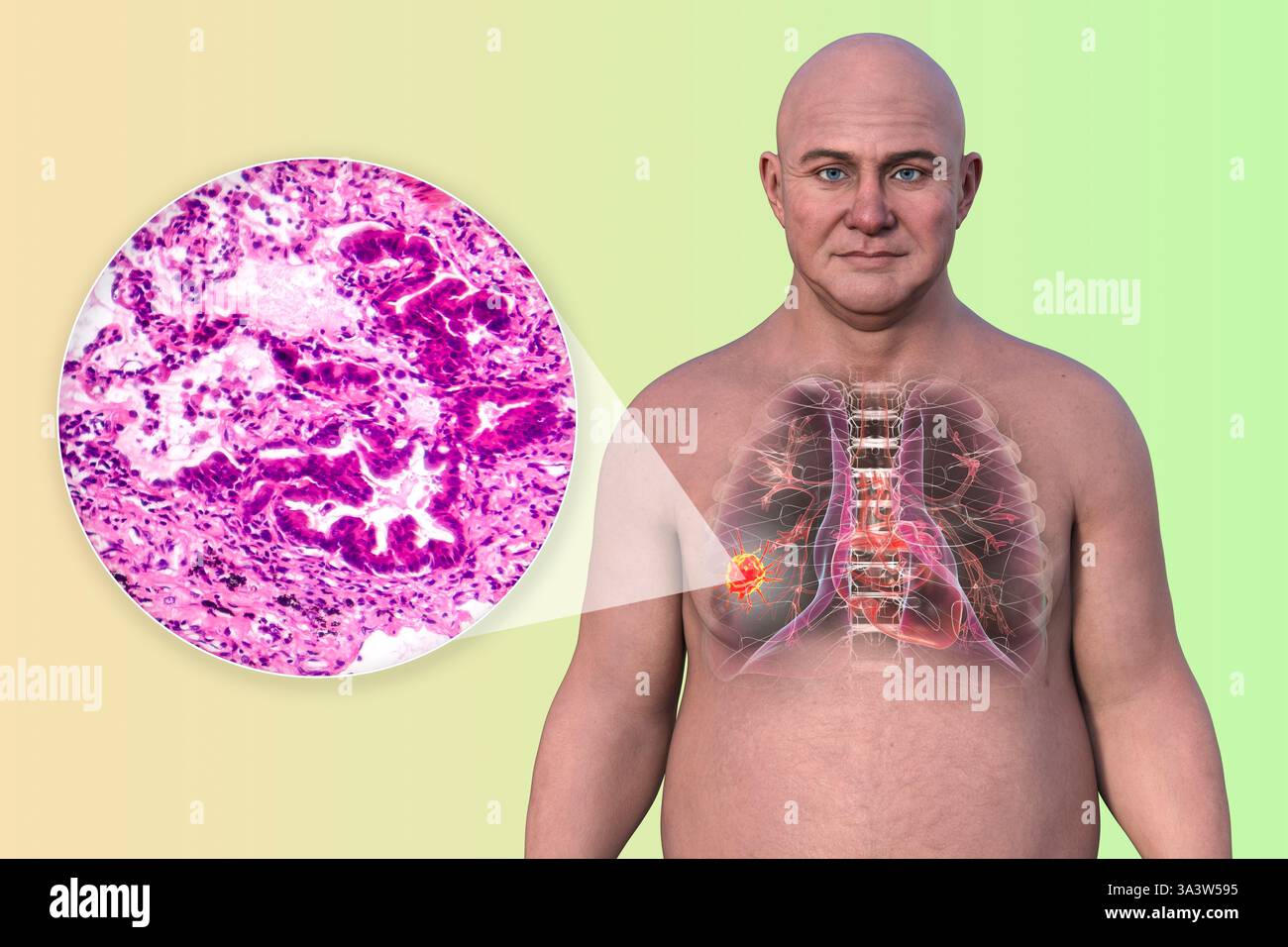 Illustration of a man with lung cancer, showing the location and gross ...