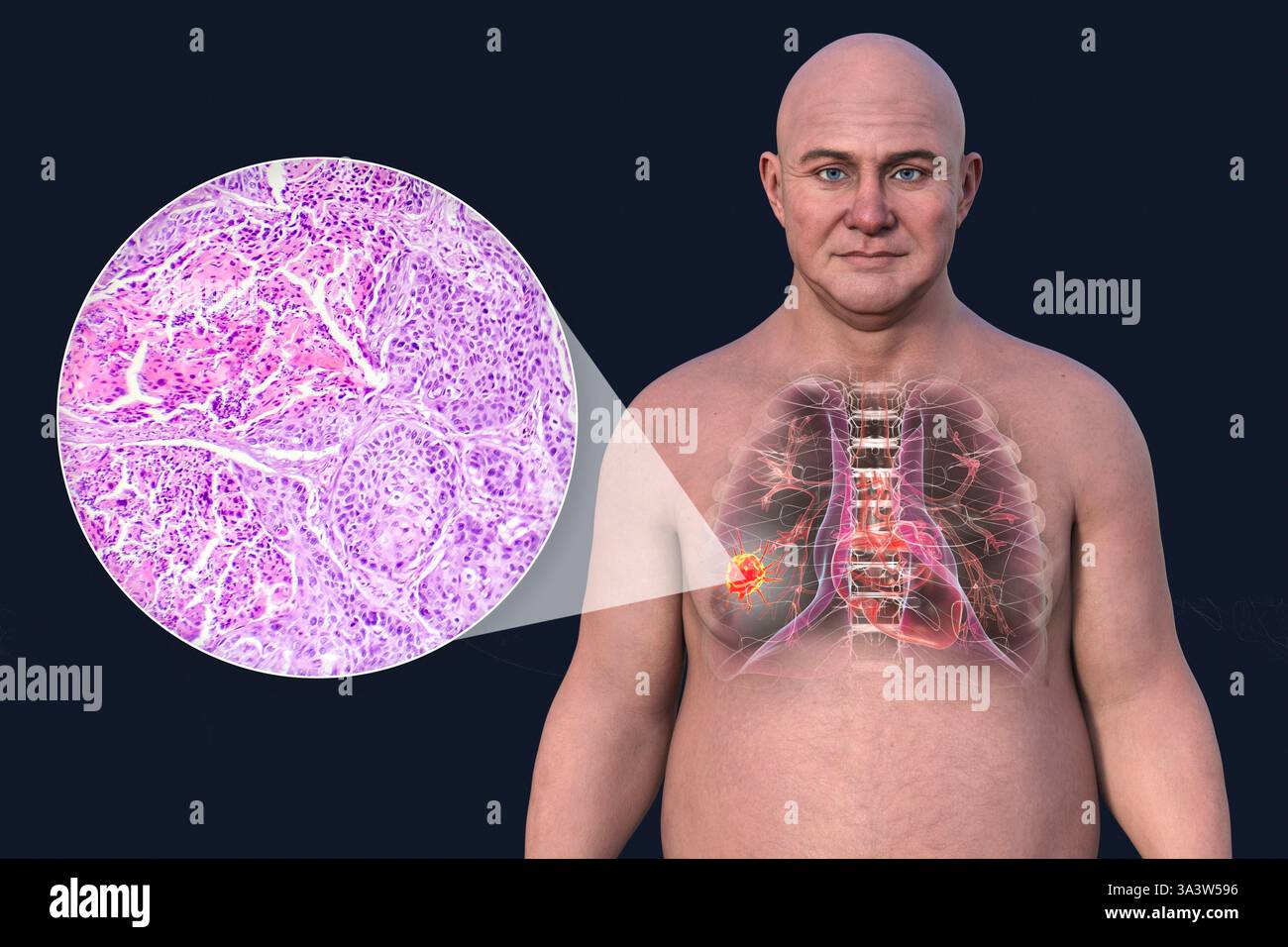 Illustration of a man with lung cancer, showing the location and gross ...
