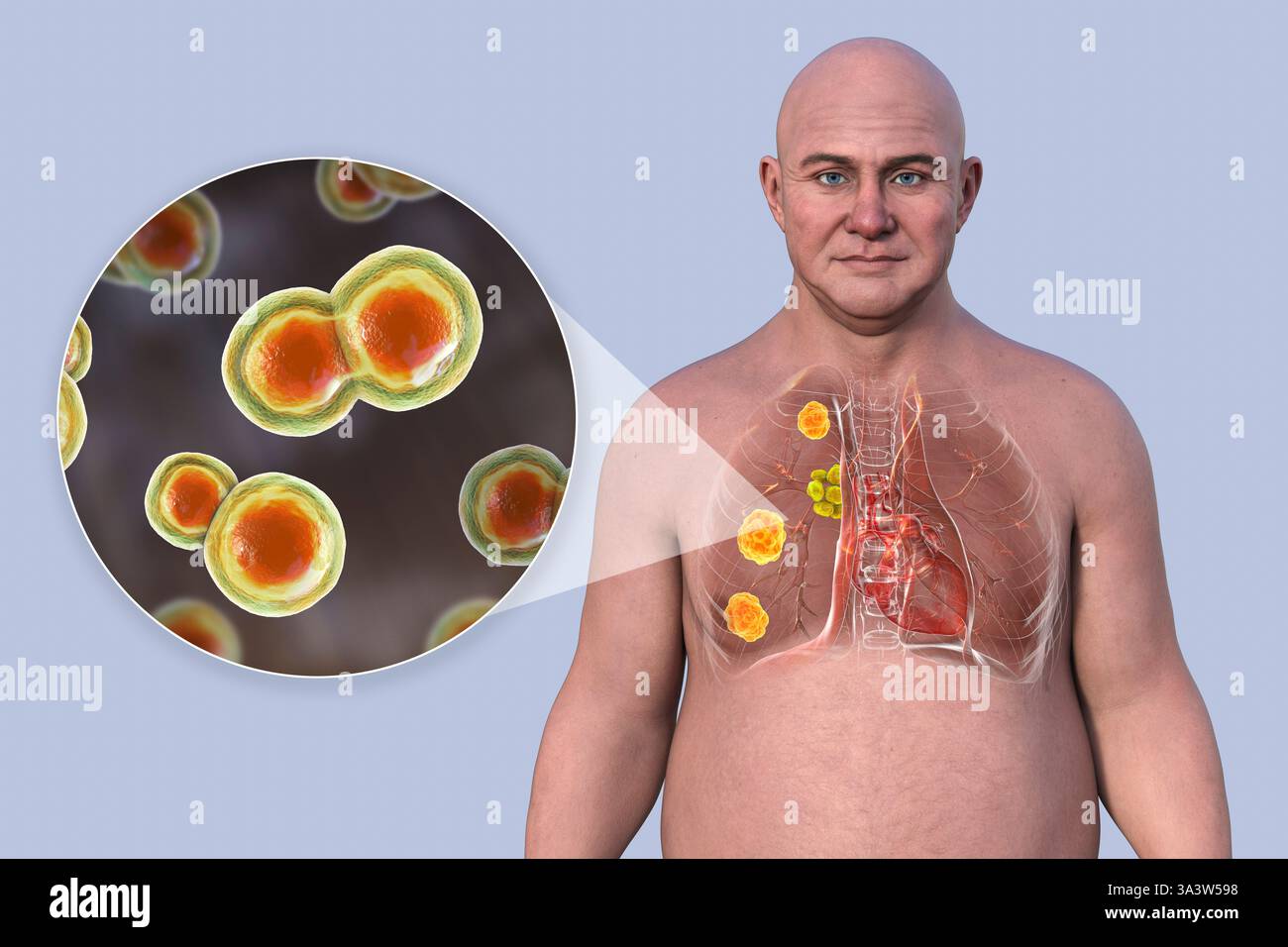 Illustration of human lungs affected by blastomycosis, a fungal ...