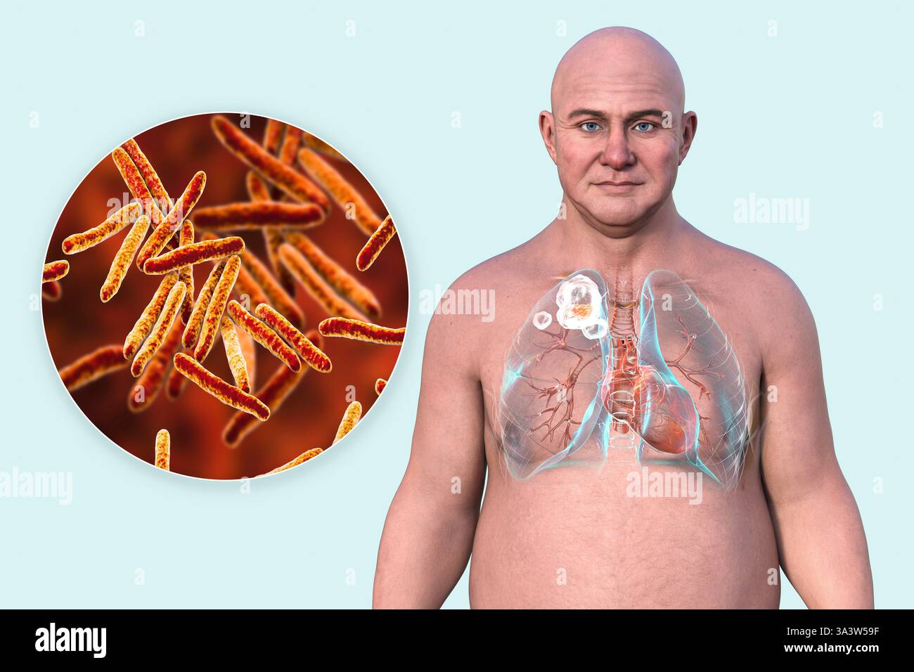 Illustration of a man with lungs affected by cavitary tuberculosis in ...