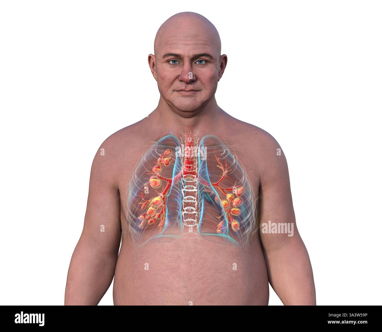 Illustration of a man with lungs affected by cystic fibrosis, a genetic ...