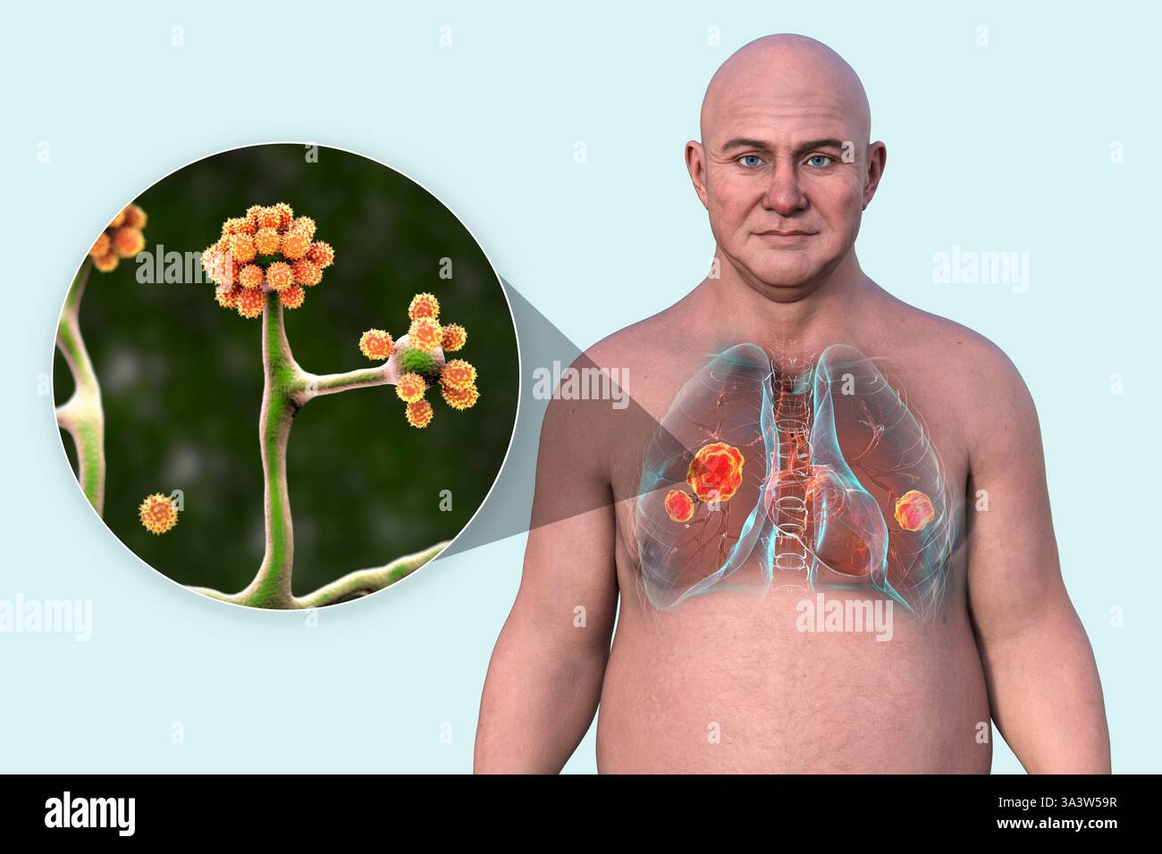 Illustration of a man with lung mucormycosis, featuring multiple ...