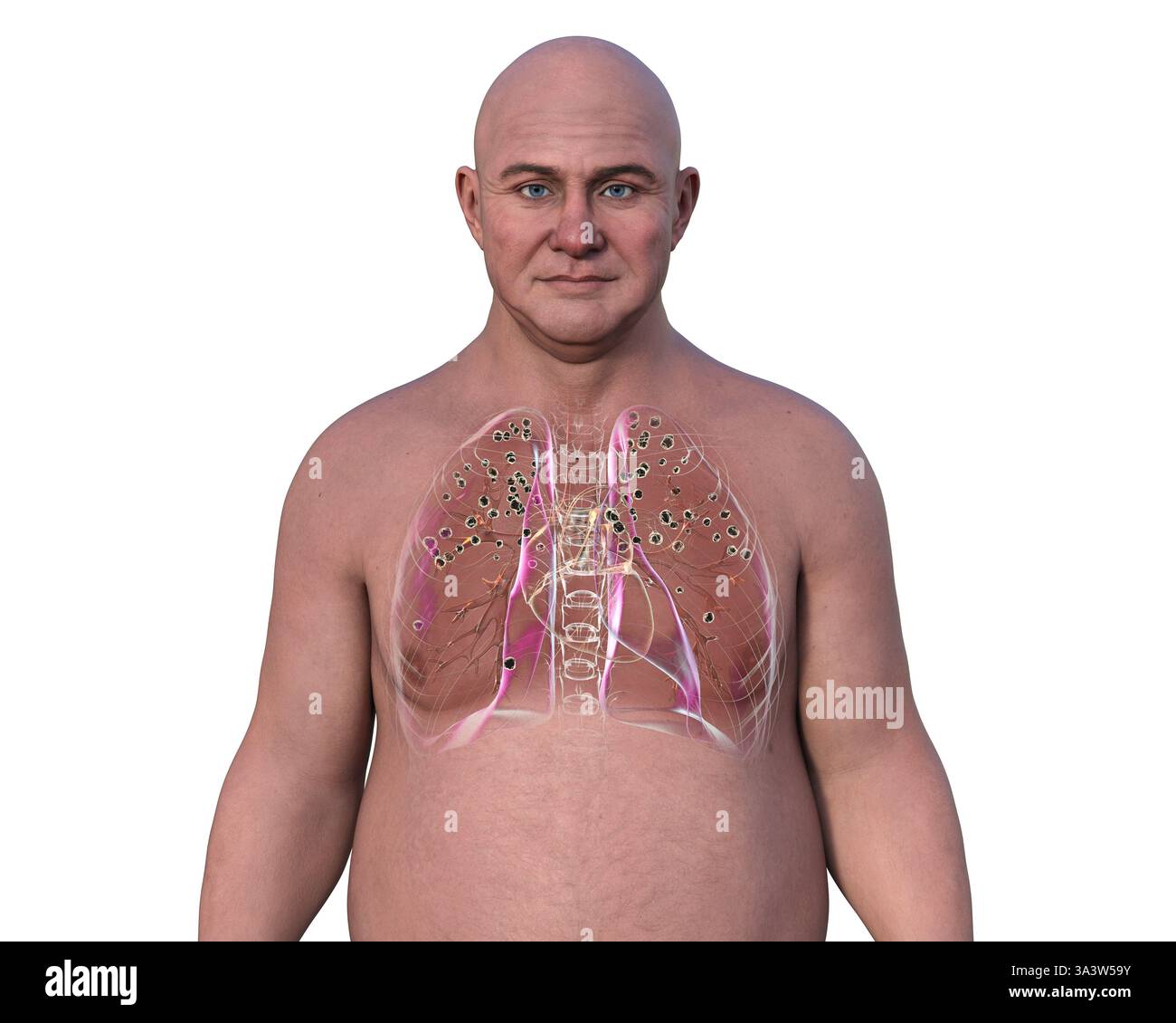 Illustration of a man with lungs affected by silicosis, a respiratory ...