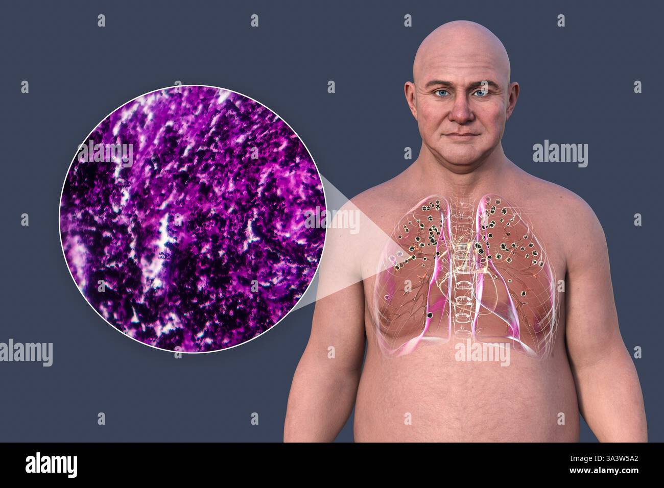 Illustration of a man with lungs affected by silicosis, a respiratory ...