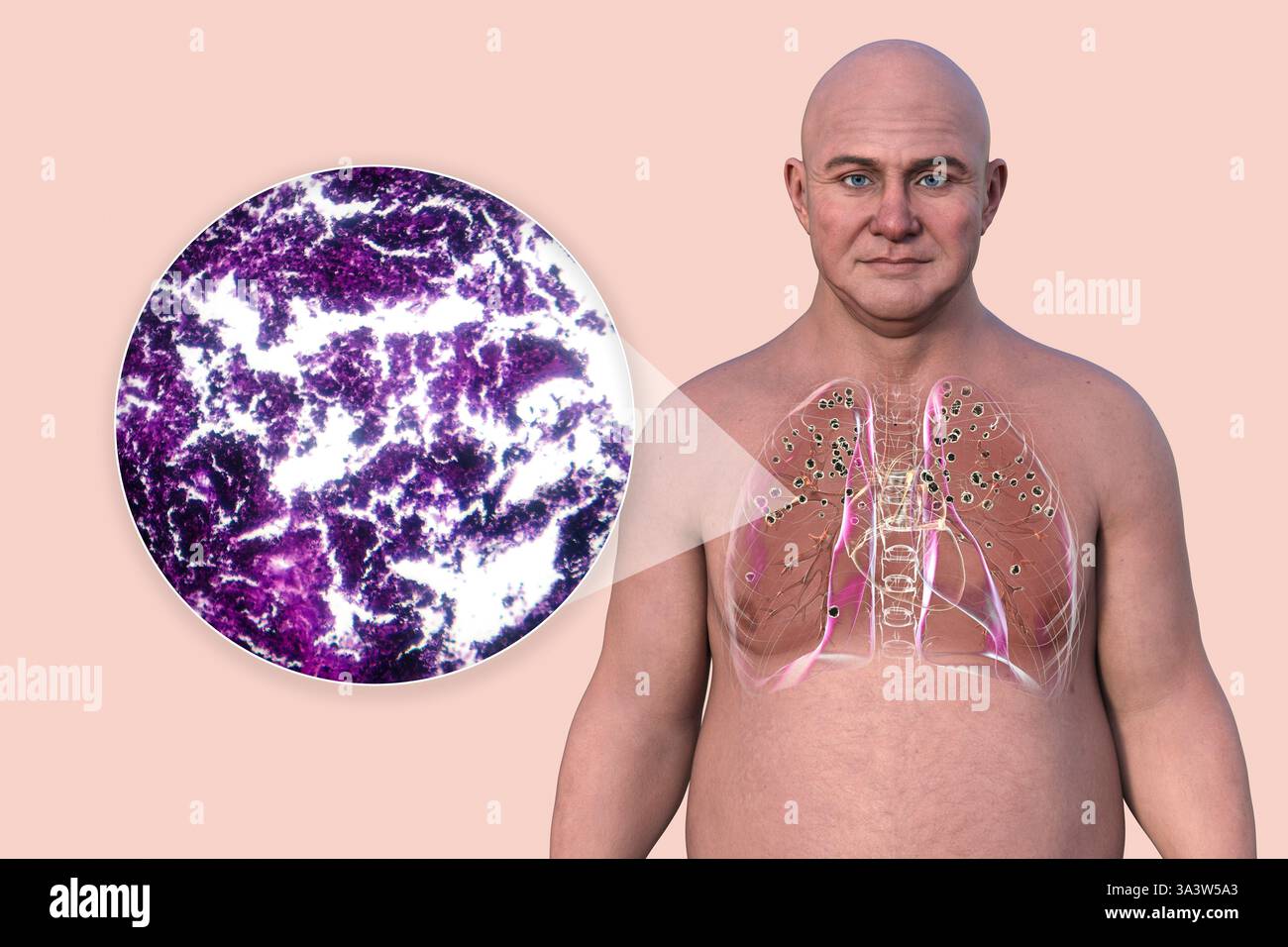 Illustration of a man with lungs affected by silicosis, a respiratory ...