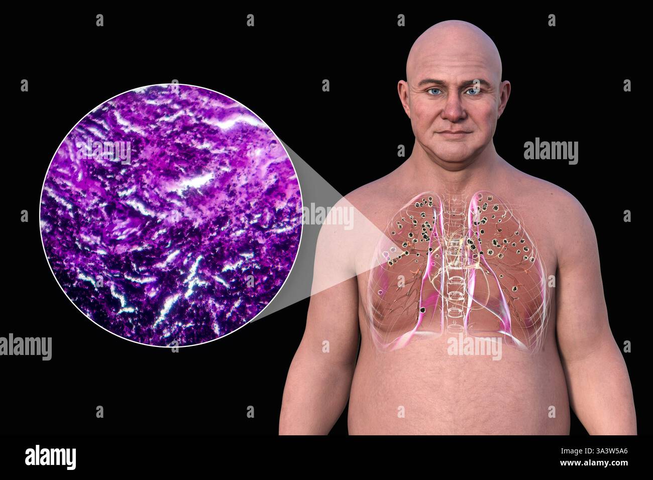 Illustration of a man with lungs affected by silicosis, a respiratory ...