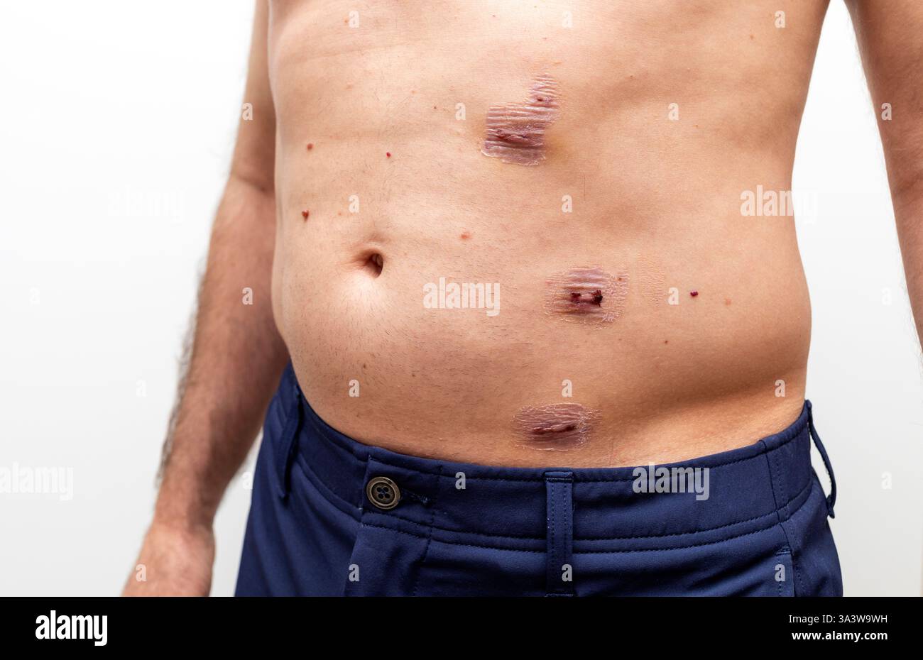 Closeup Scars On Abdomen After Removal Of Appendicitis And Abdominal ...