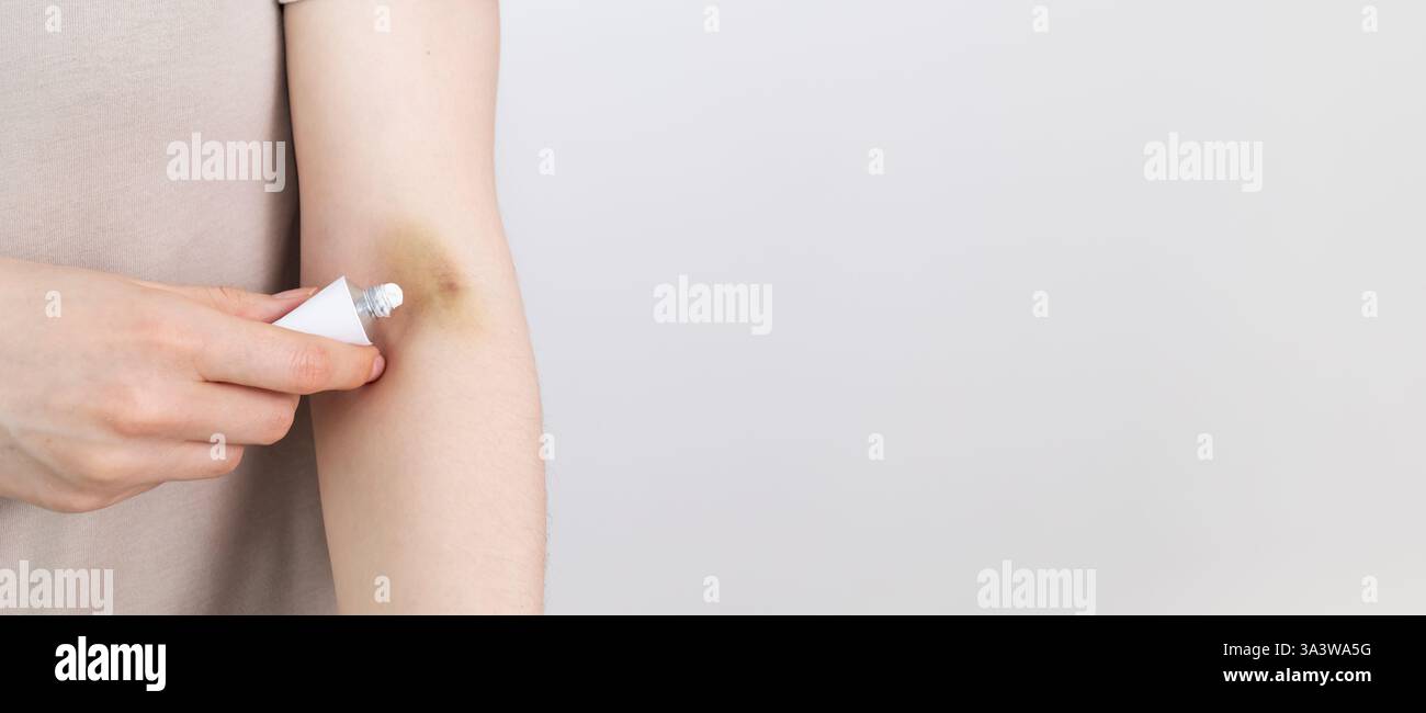 Banner Female Person Applies Healing Cream, Ointment On Hematoma ...