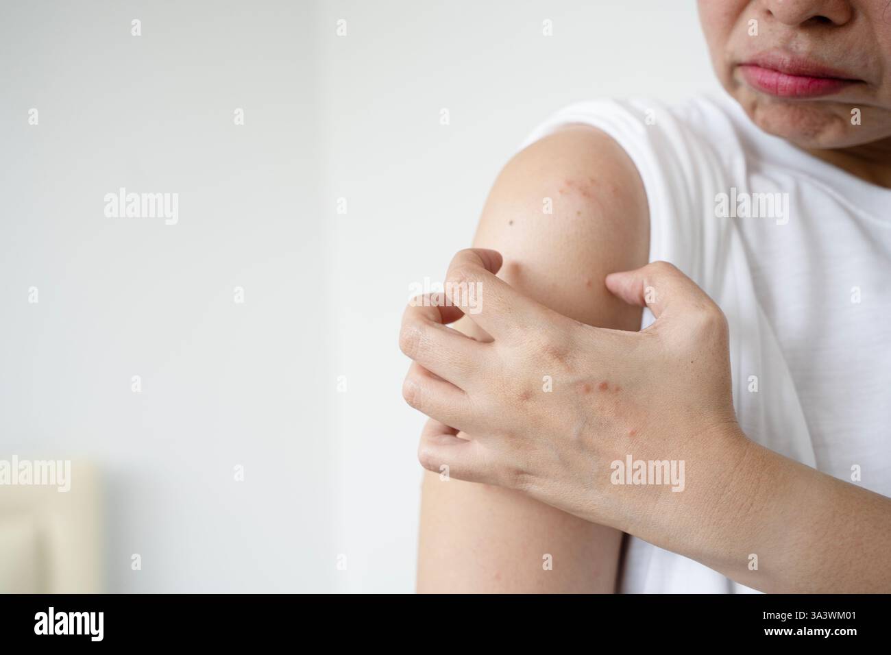 An allergic reaction causeing a severe case of hives. Women with ...