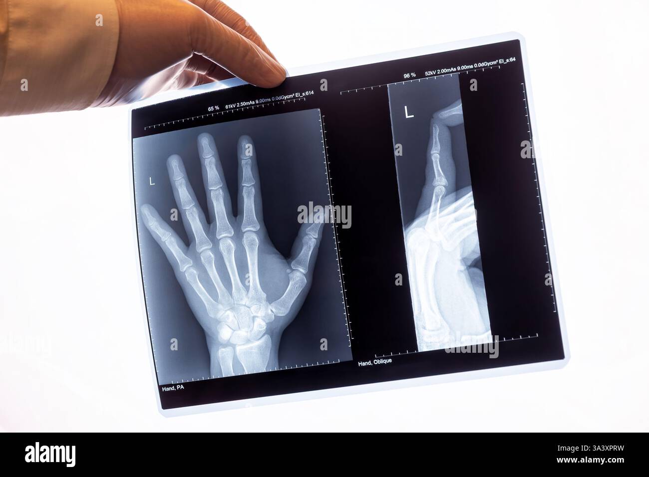 A gloved hand holds up a digital x-ray image of a hand showing two ...