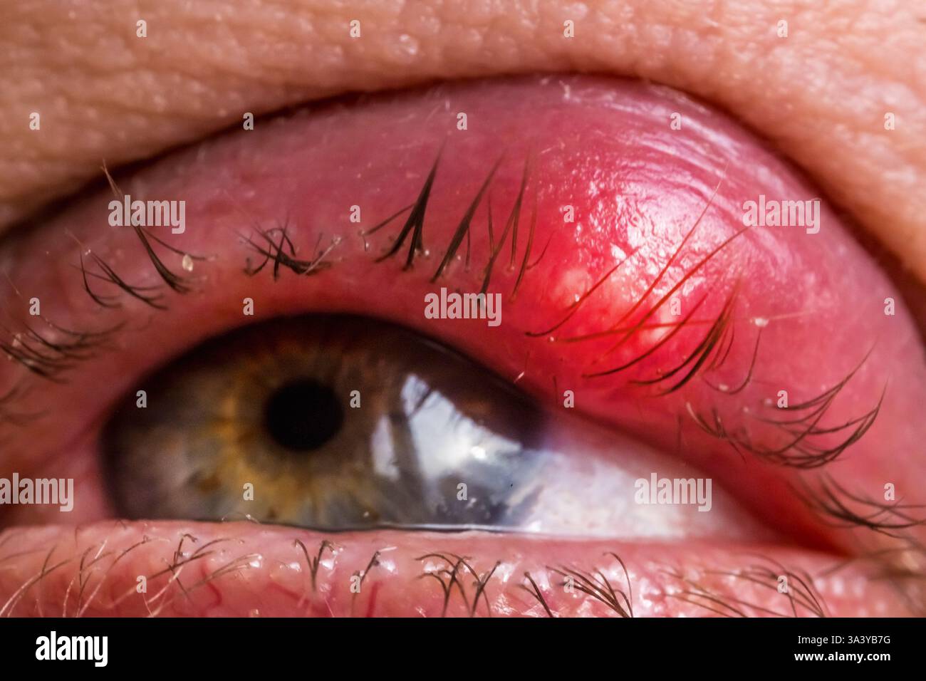 disease barley on the eye. redness of the skin and inflammation of the ...